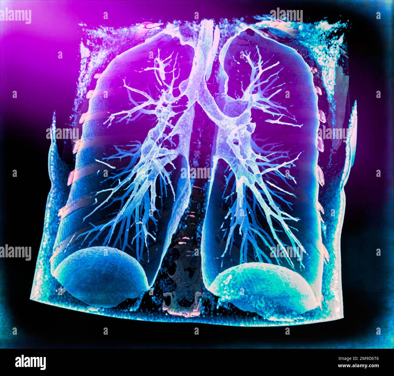 Healthy lungs, CT scan Stock Photo - Alamy