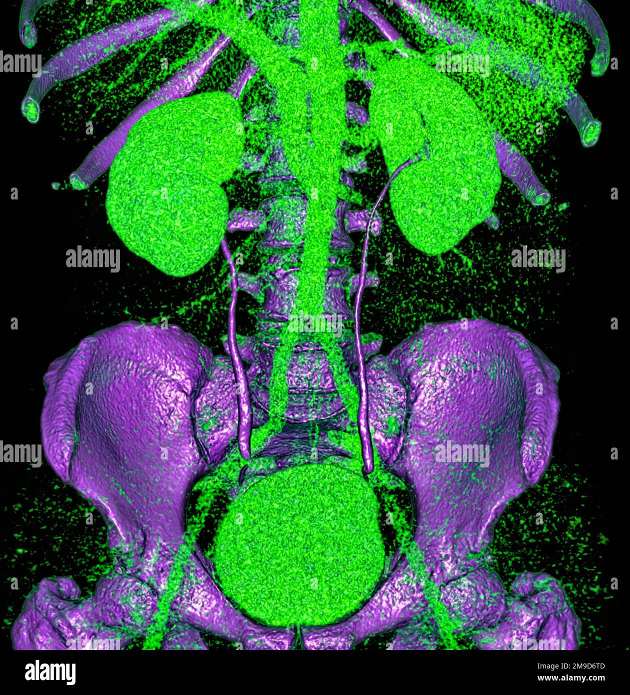 Urinary system, CT scan Stock Photo - Alamy