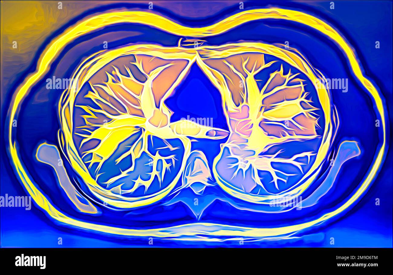 Healthy lungs, CT scan Stock Photo - Alamy