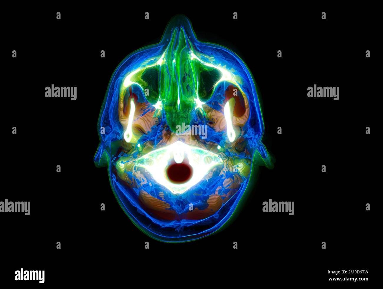 Paranasal sinuses, CT scan Stock Photo - Alamy Paranasal sinuses, CT scan Stock Photo - Alamy