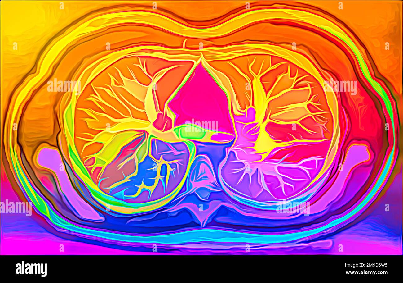 Healthy lungs, CT scan Stock Photo - Alamy