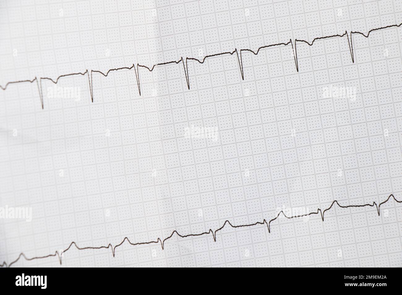 Cardiogram Waves Of Heart Beat Ekg On The Paper Arrhythmia Stock