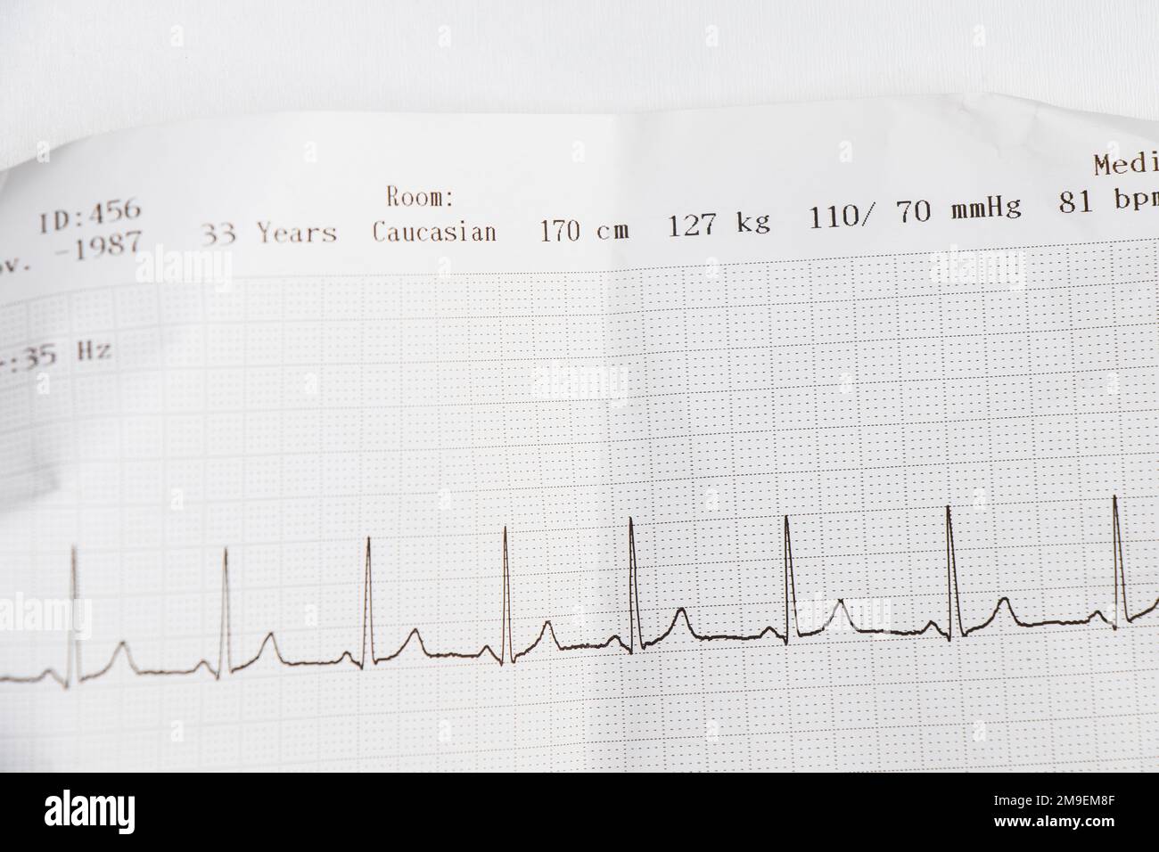 Cardiogram, waves of heart beat, EKG on the paper, arrhythmia Stock ...