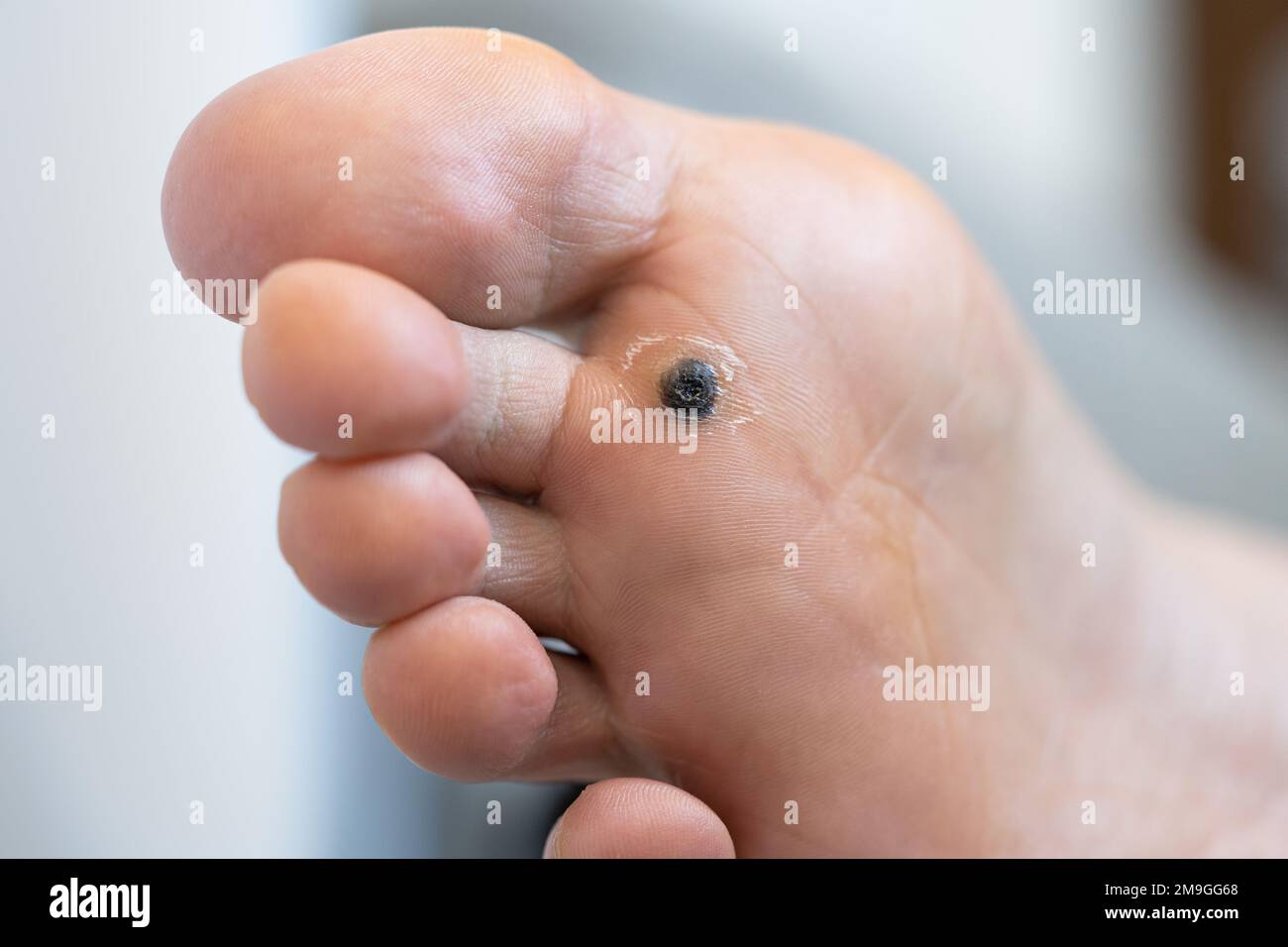 Closeup of wart plantar after cauterizing it with celandine on infected ...