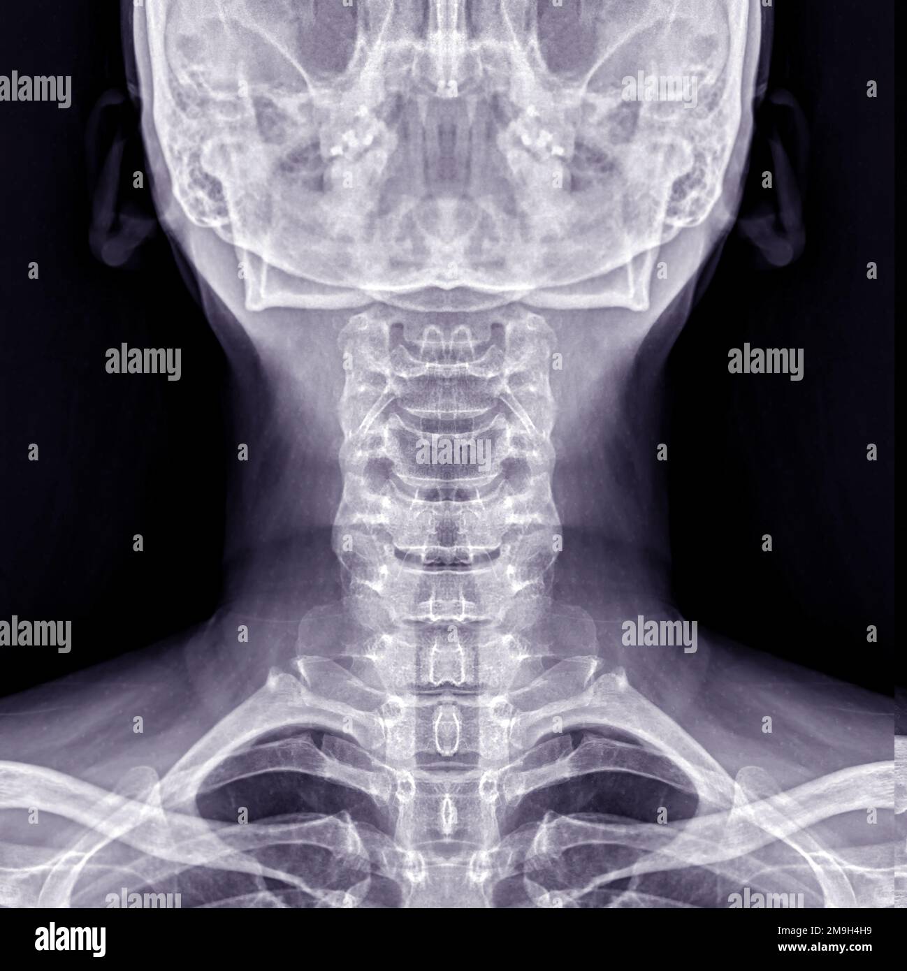 Adenoid Hypertrophy X Ray
