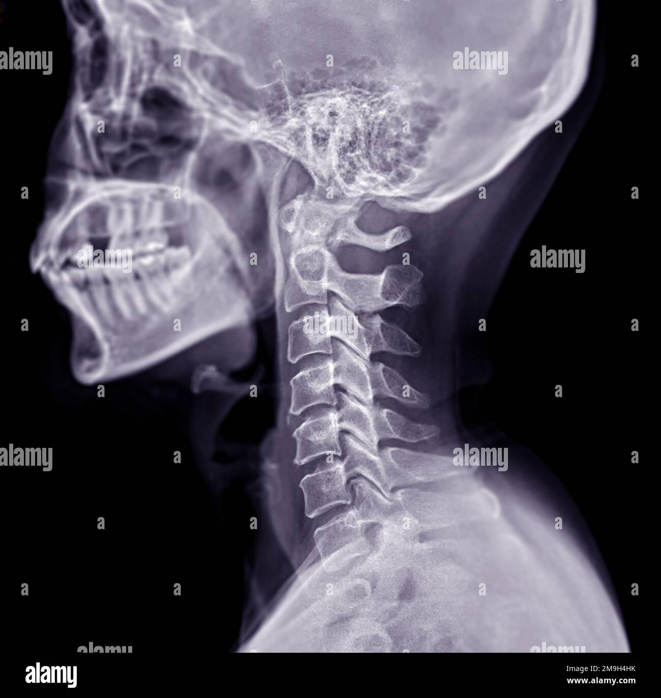 X Ray C Spine Or X Ray Image Of Cervical Spine Lateral View For