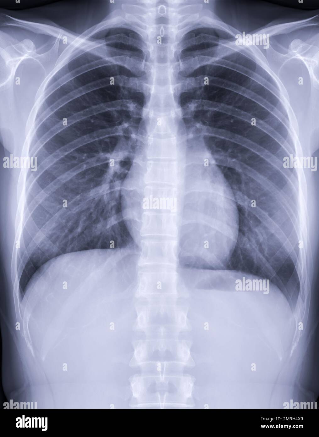 Chest X Ray For Tb Diagnosis at Timothy Orear blog