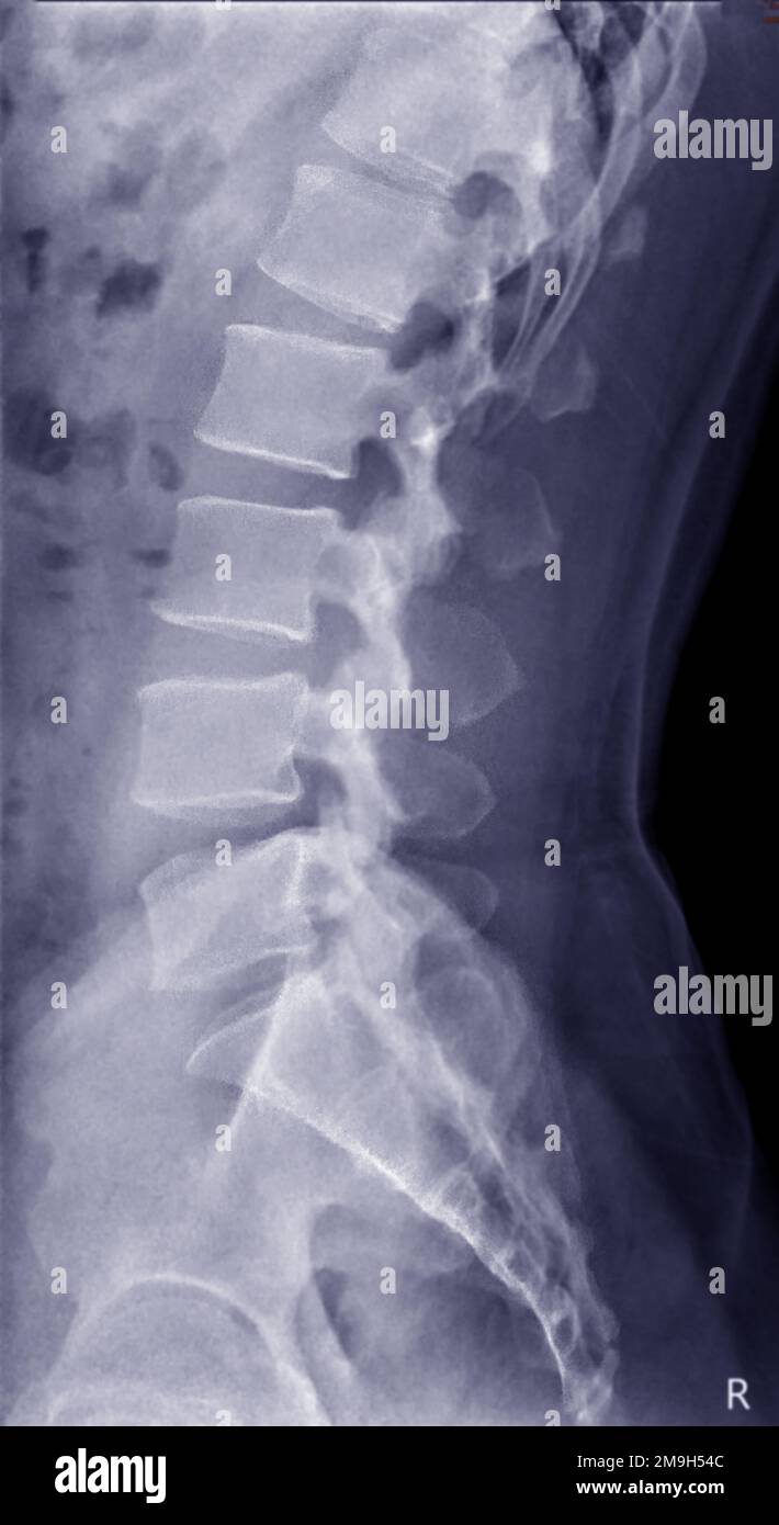 X-ray image of lambosacral spine or L-S spine Stock Photo - Alamy