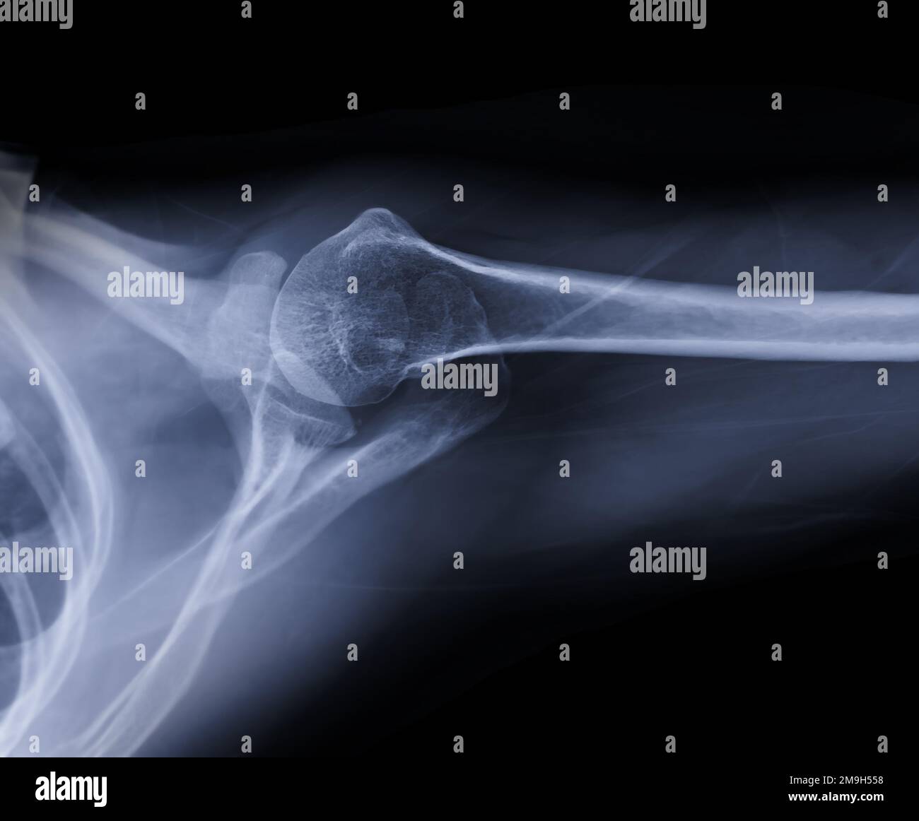 X Ray Shoulder Joint Shoulder Transaxillary View For Diagnosis Fracture Of Shoulder Joint Stock