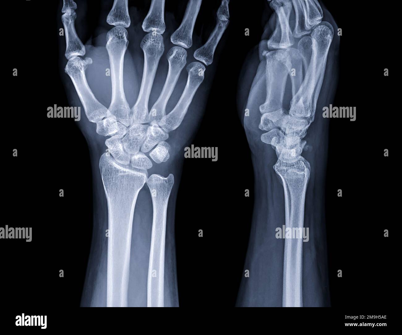 Hand x ray ring hi-res stock photography and images - Alamy