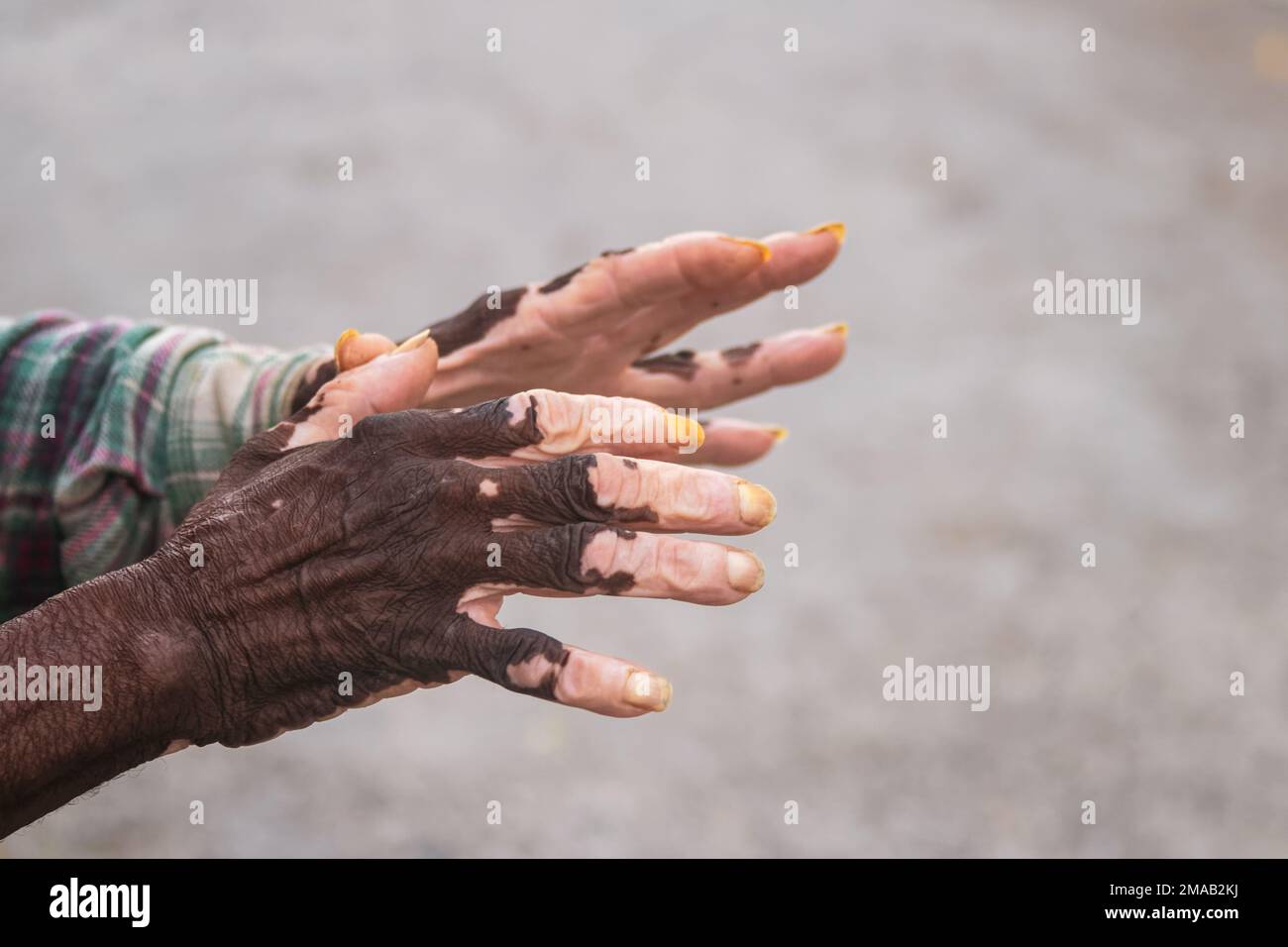 The hands of an old black man with the vitiligo skin disease on the ...