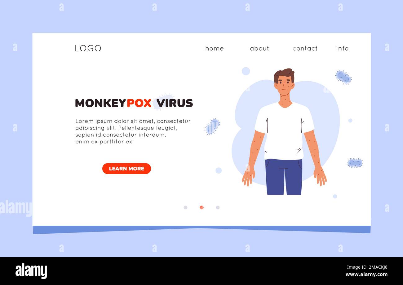 Monkeypox virus symptoms landing page. Website template of Monkeypox ...