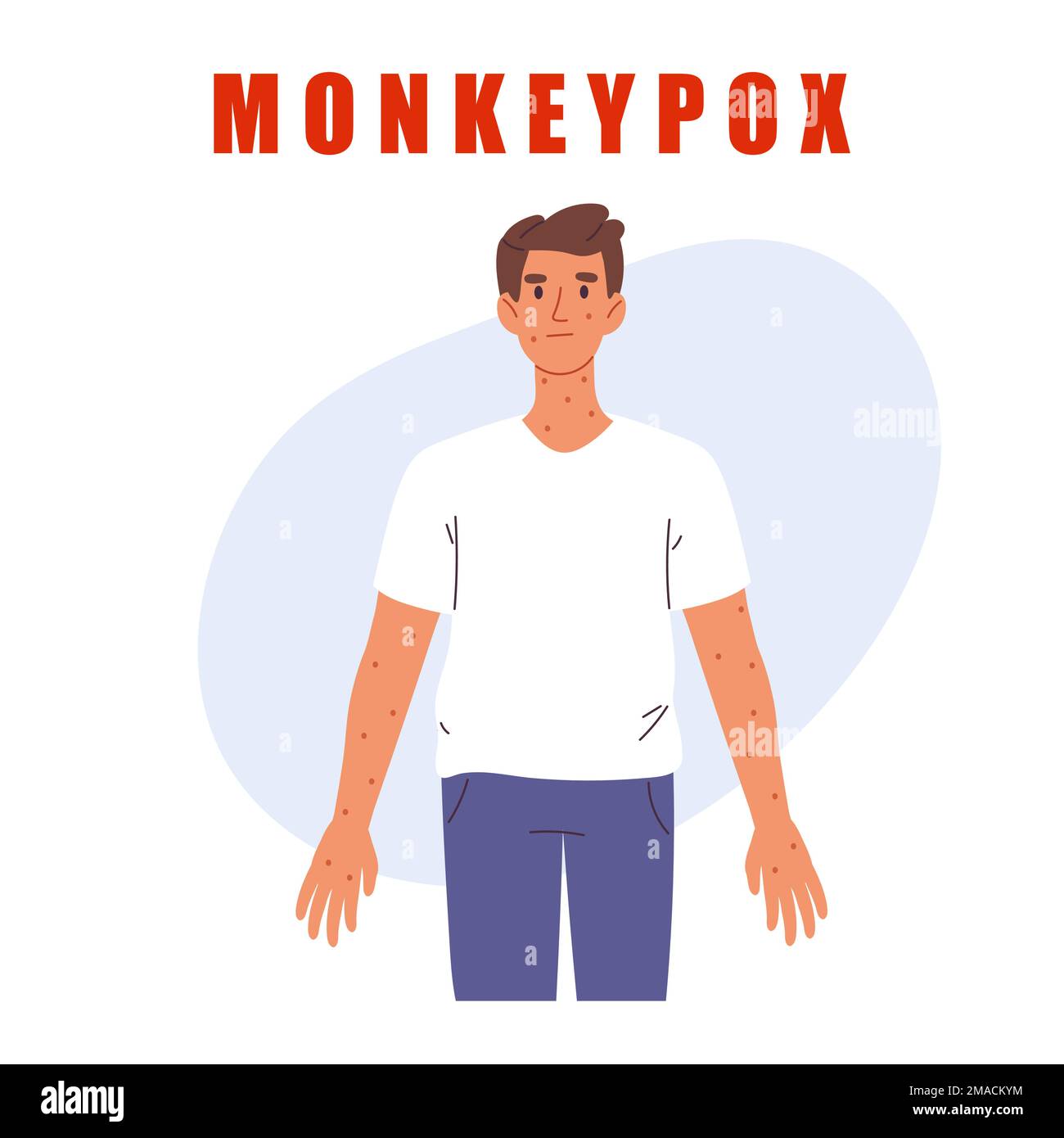 Monkeypox virus. Man with rash. Skin infections. Monkeypox virus ...