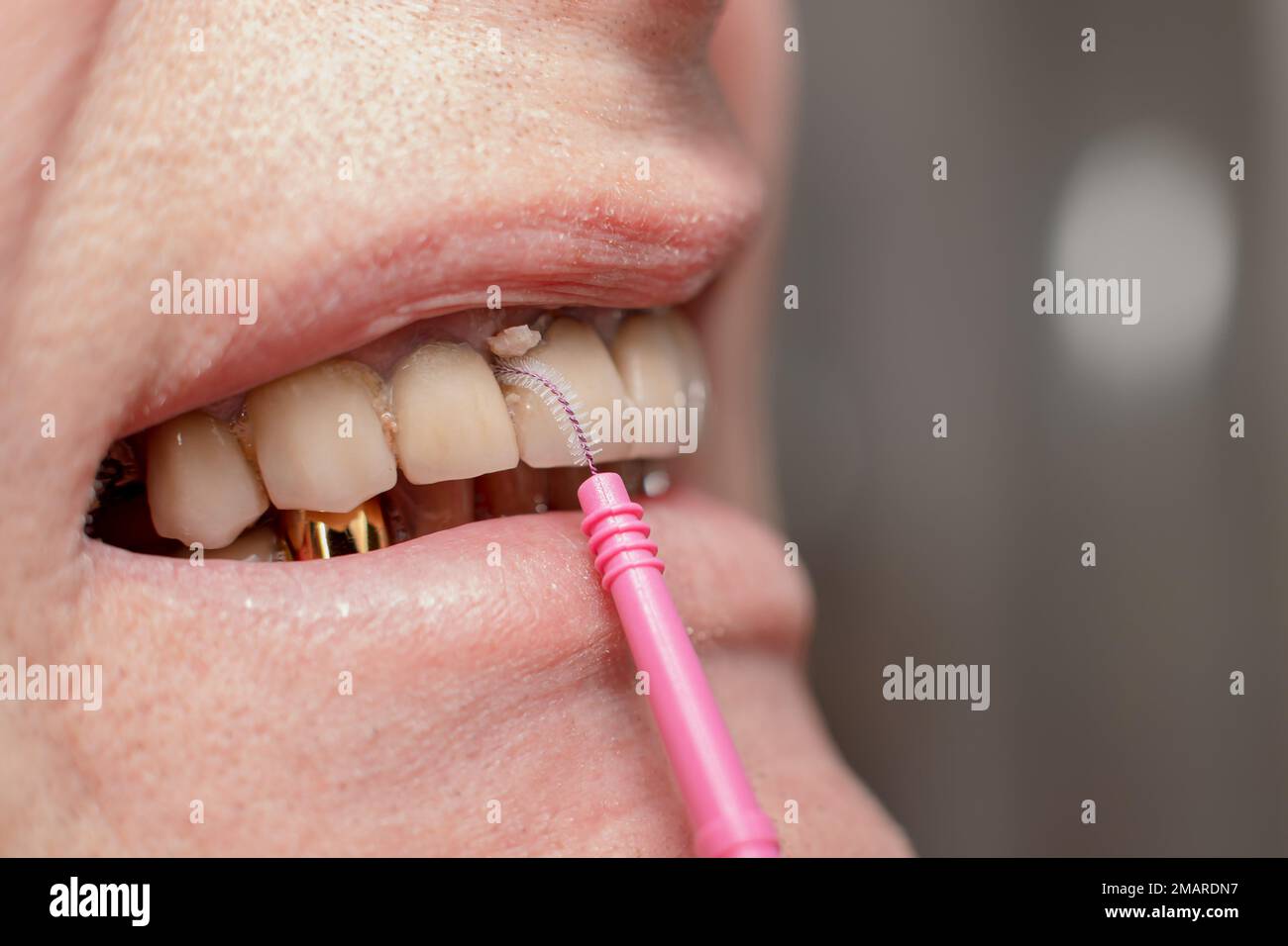Inter dental hi-res stock photography and images - Alamy