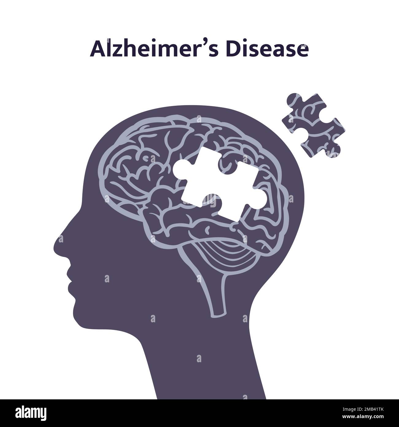 Alzheimer's disease vector illustration. Human brain lacking a piece of ...