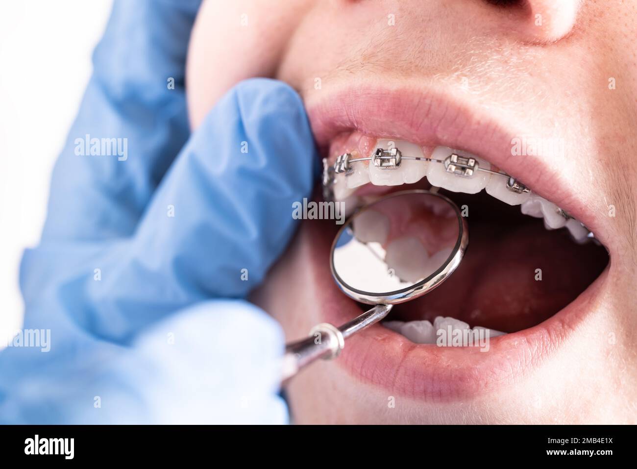 A close-up of a dental brace, a dentist-orthodontist checks the tension ...