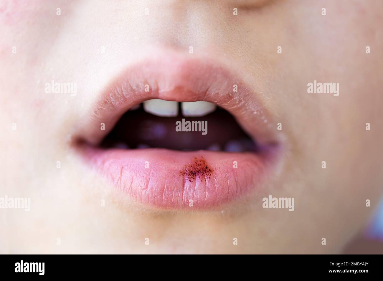 Lesion on a child's lip with blood Stock Photo - Alamy