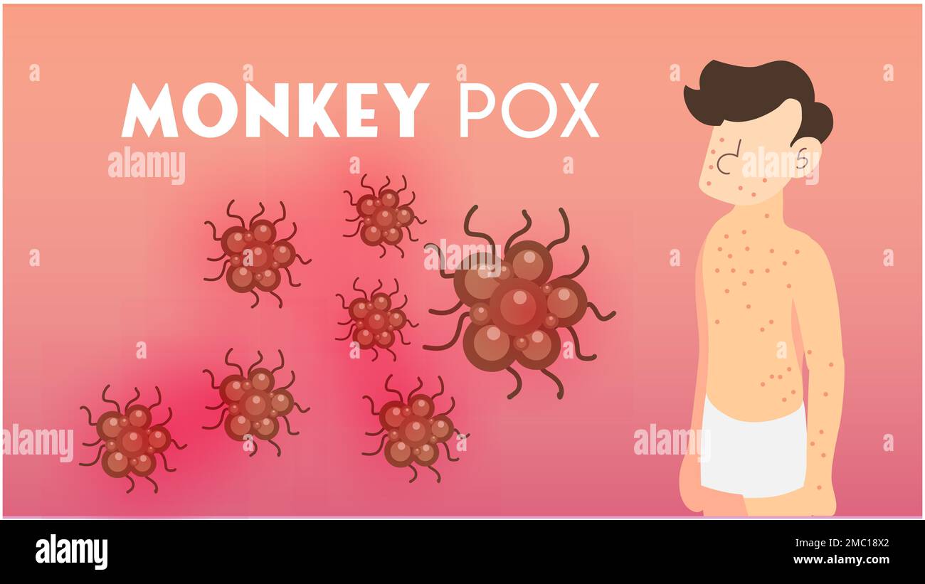 Illustration of monkeypox virus, Vector of a person with monkeypox ...