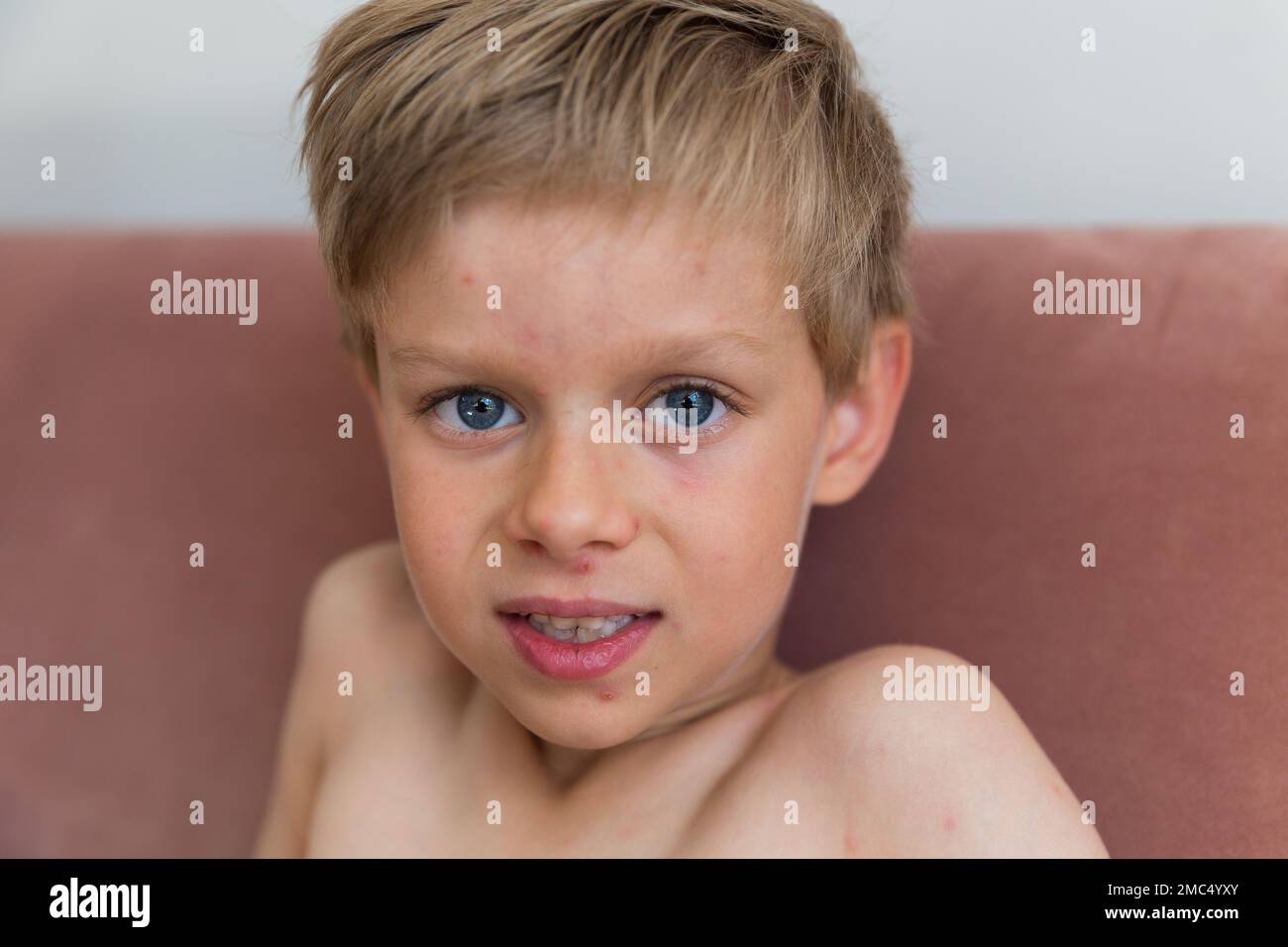Young toddler with chickenpox. Sick child with chickenpox. Varicella ...