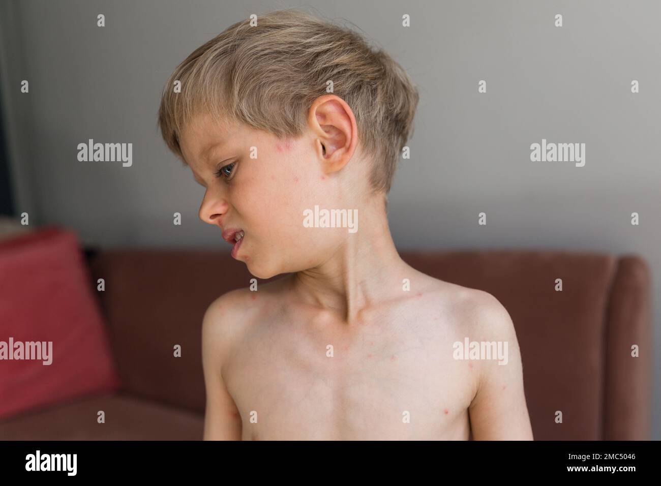 Young toddler with chickenpox. Sick child with chickenpox. Varicella ...