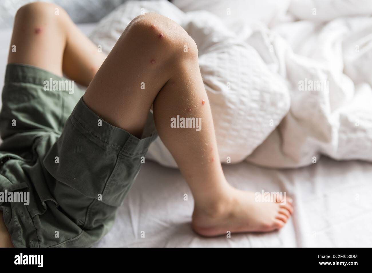 Young toddler with chickenpox. Sick child with chickenpox. Varicella ...