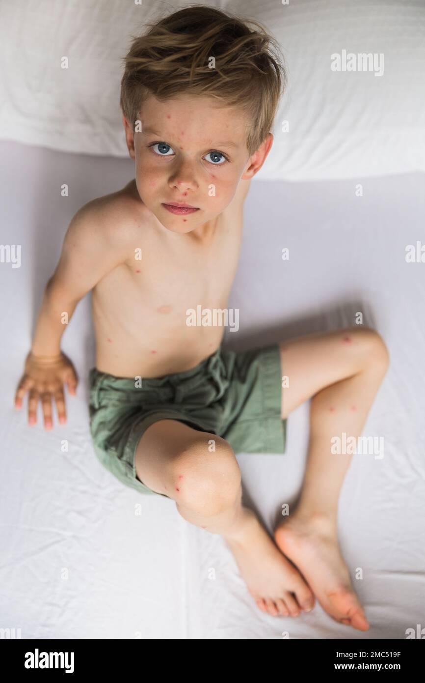 Young toddler with chickenpox. Sick child with chickenpox. Varicella virus or Chickenpox bubble ...