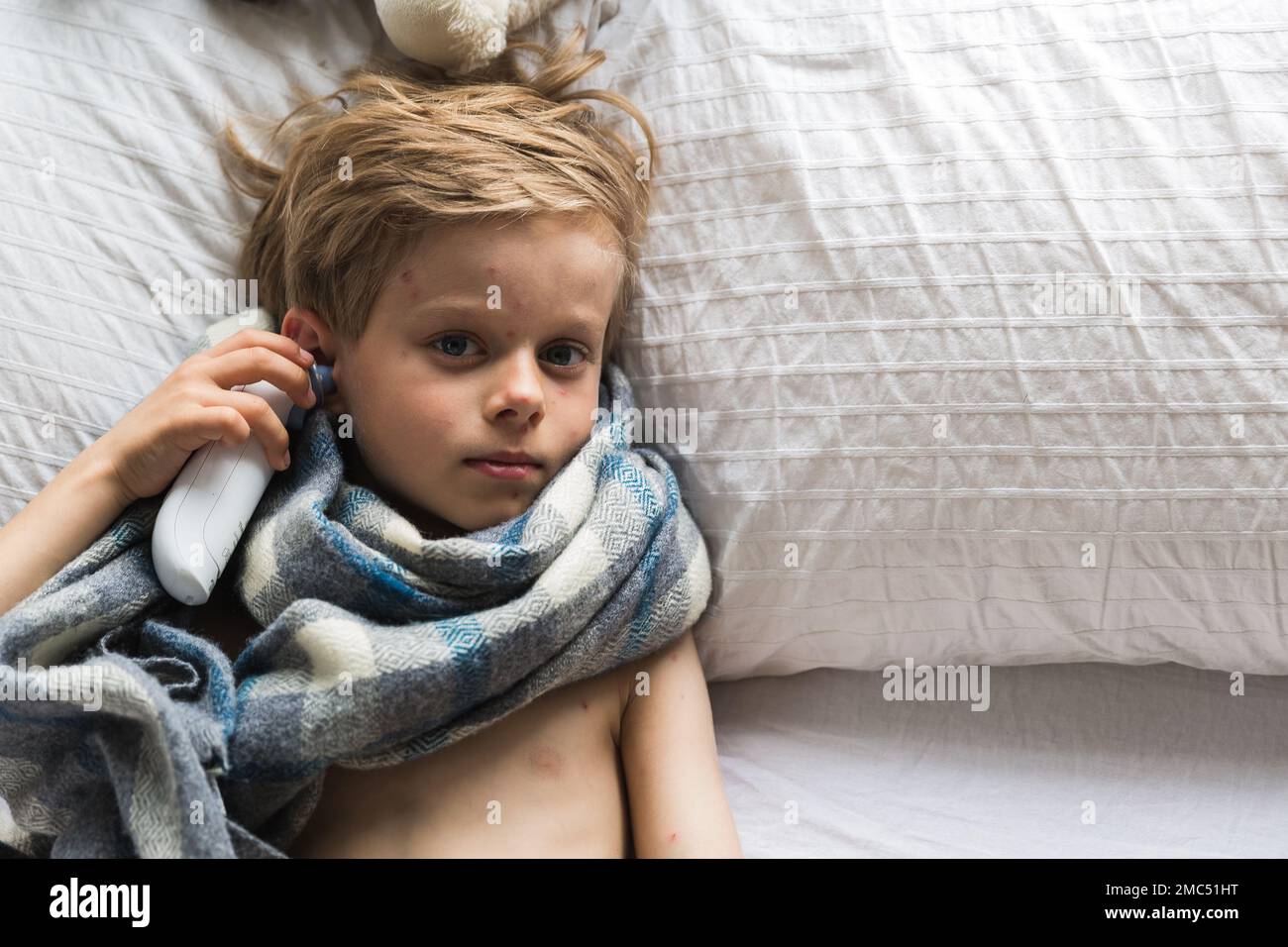 Young toddler with chickenpox. Sick child with chickenpox. Varicella ...