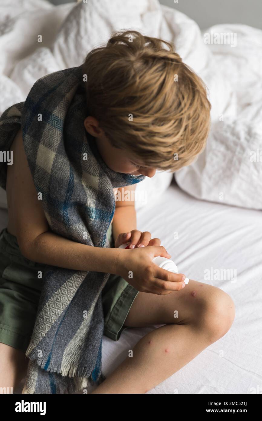 Young toddler with chickenpox. Sick child with chickenpox. Varicella ...