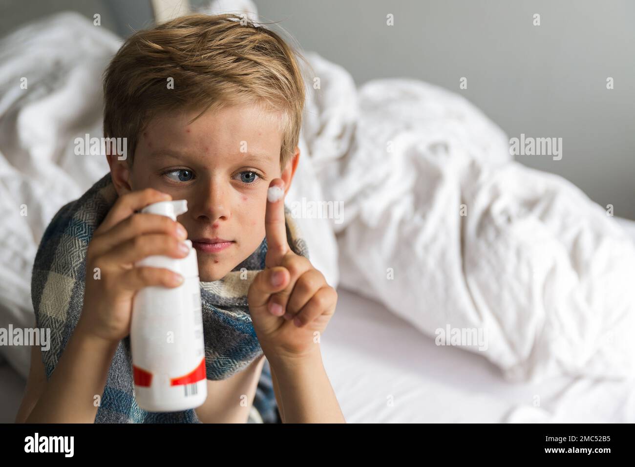 Young toddler with chickenpox. Sick child with chickenpox. Varicella ...