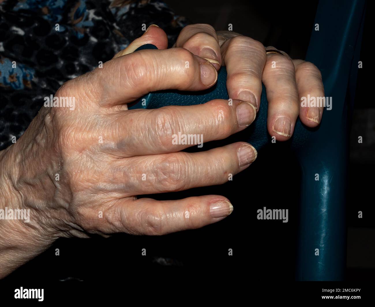 Hand deformity hi-res stock photography and images - Alamy