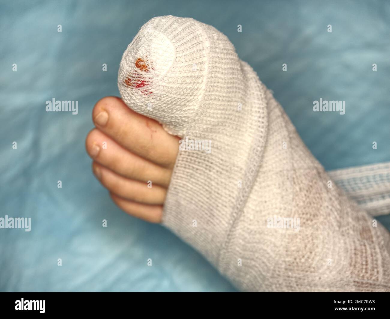 Leg of the bite victim is tied with white sterile bandage. Blood injury ...