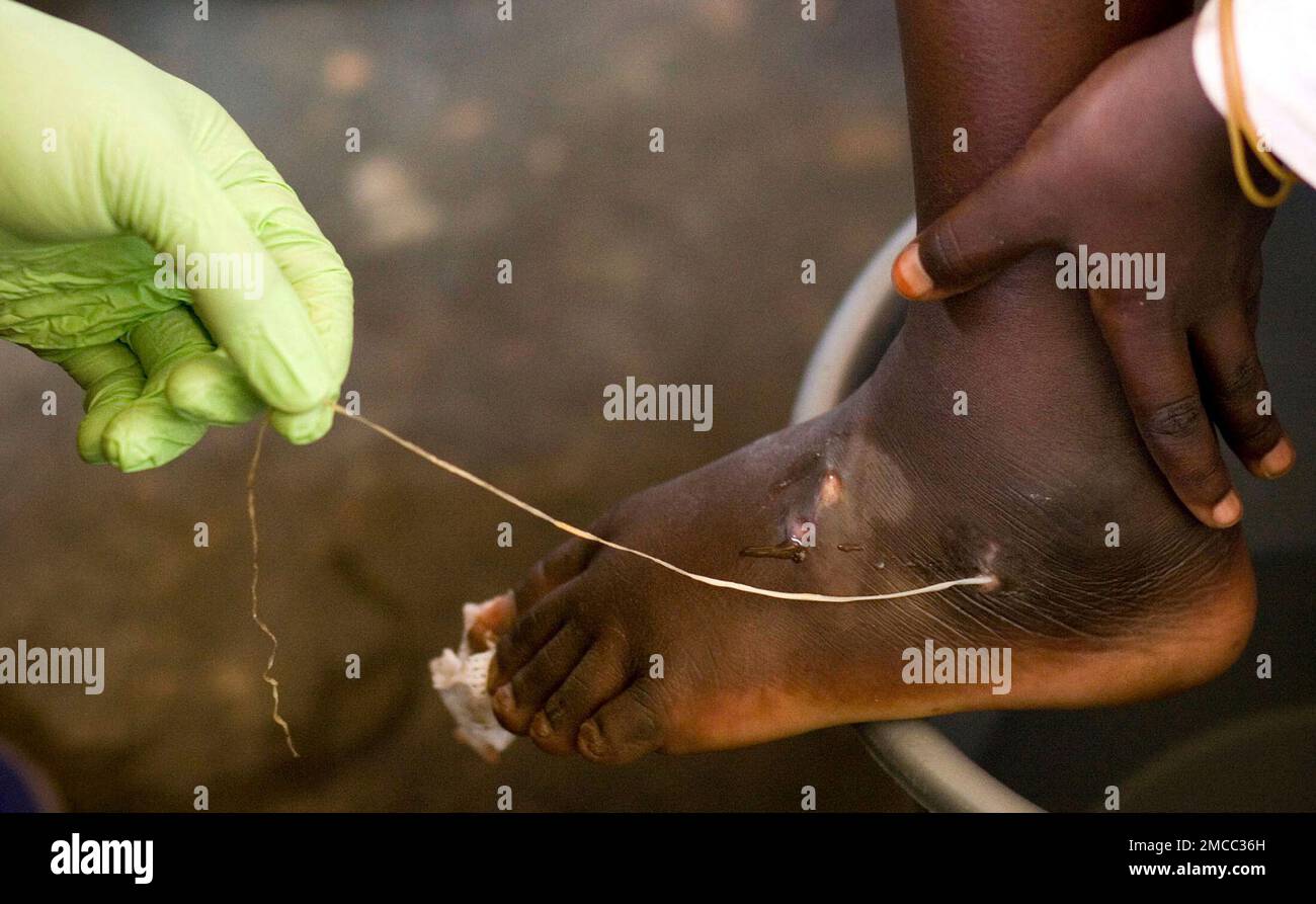 FILE - In this March 9, 2007, file photo, a Guinea worm is extracted by ...
