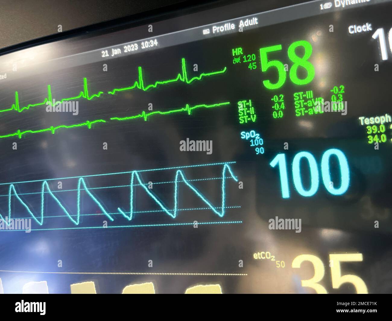 Hospital Monitors electrocardiogram pulse blood pressure anesthesia ...