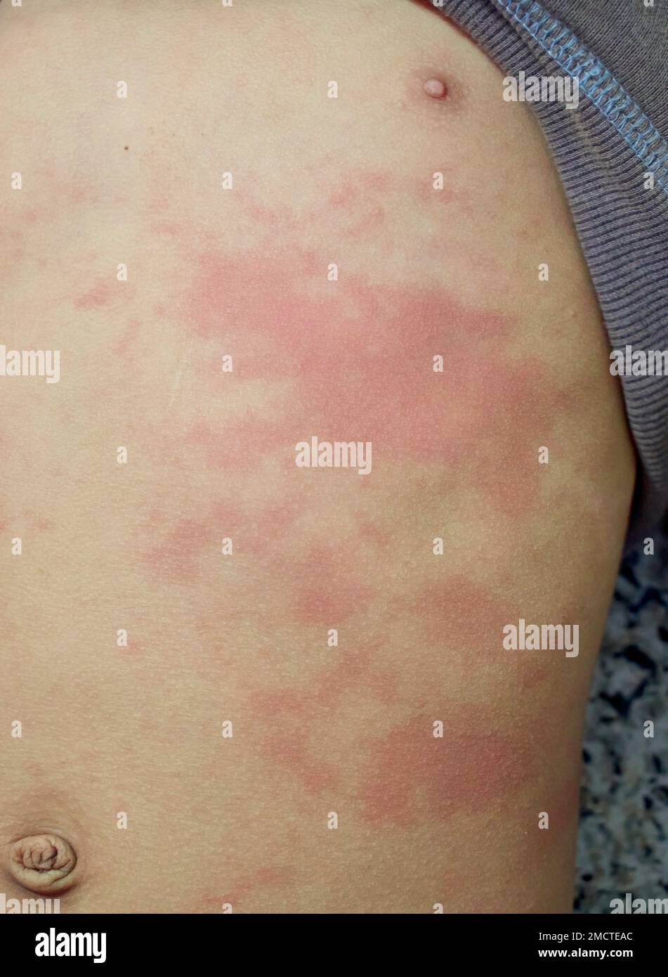 Rash Over Trunk Of Asian Young Man Widespread Macular Skin Lesions