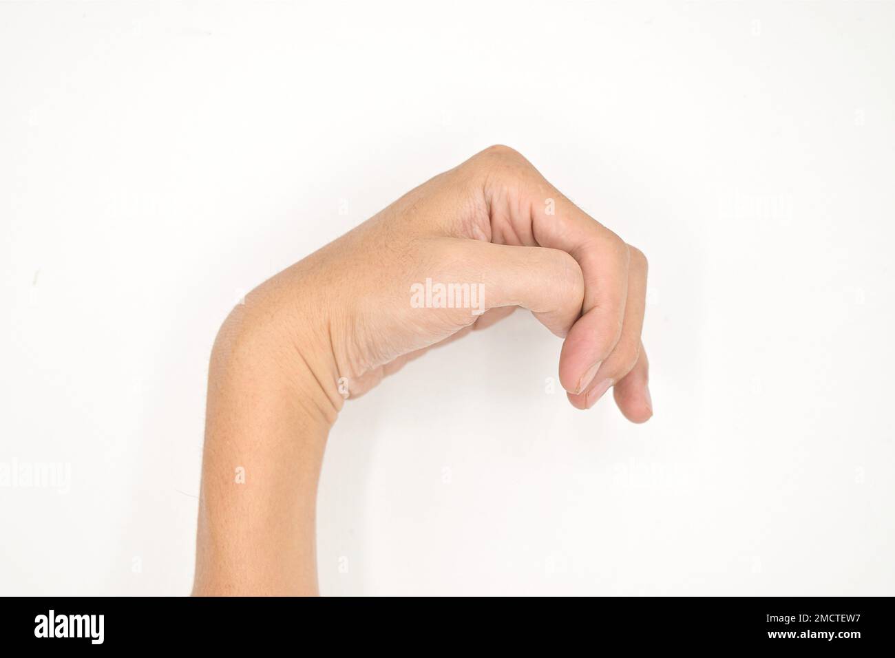 Cerebral palsy hand in Southeast Asian young male patient. Typically ...