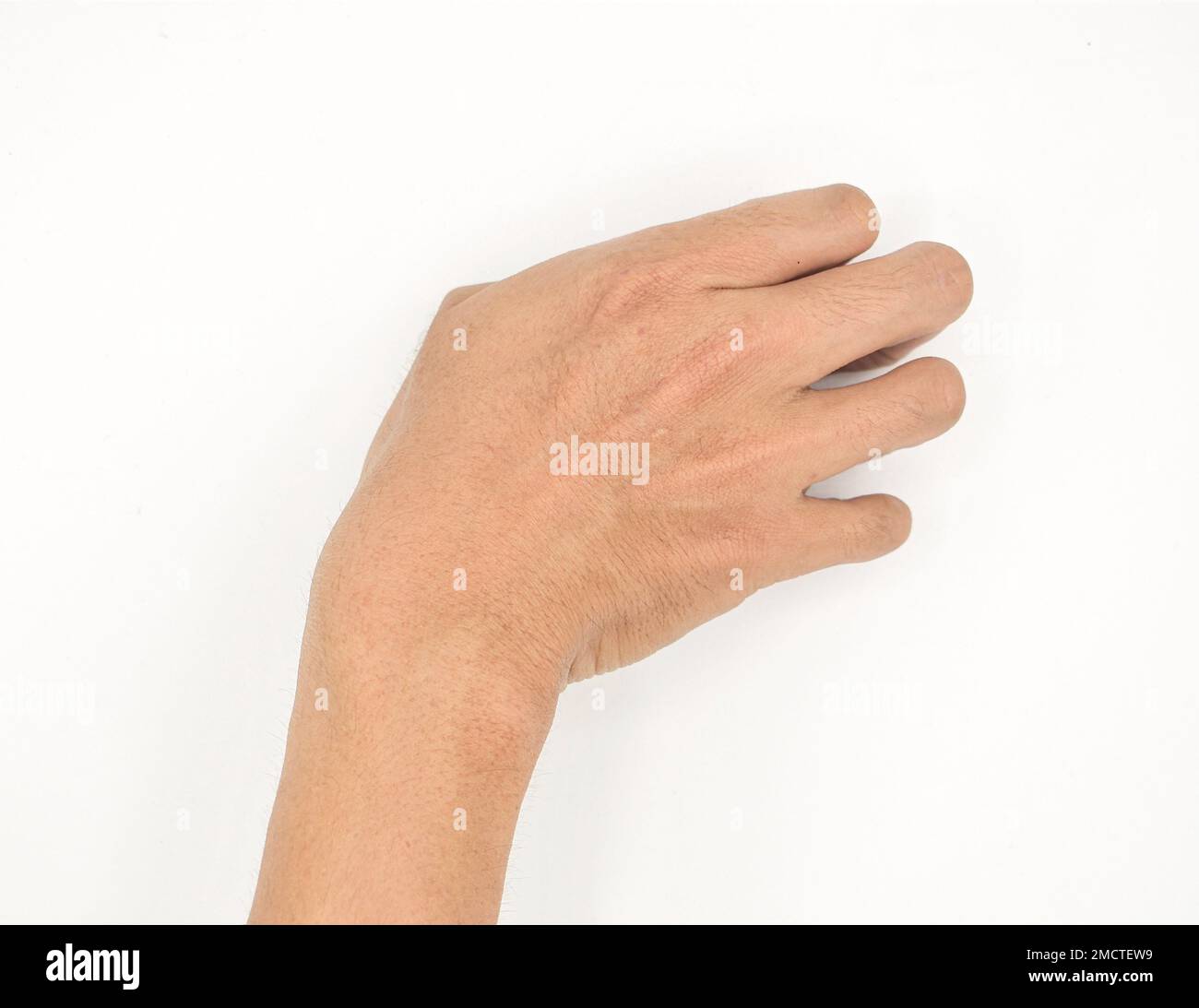 Cerebral palsy hand in Southeast Asian young male patient. Typically ...