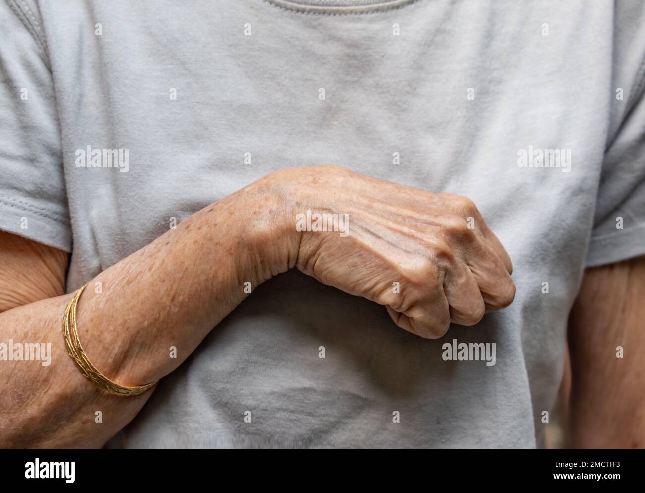 Volkmann contracture in left upper limb of Southeast Asianold woman. It ...