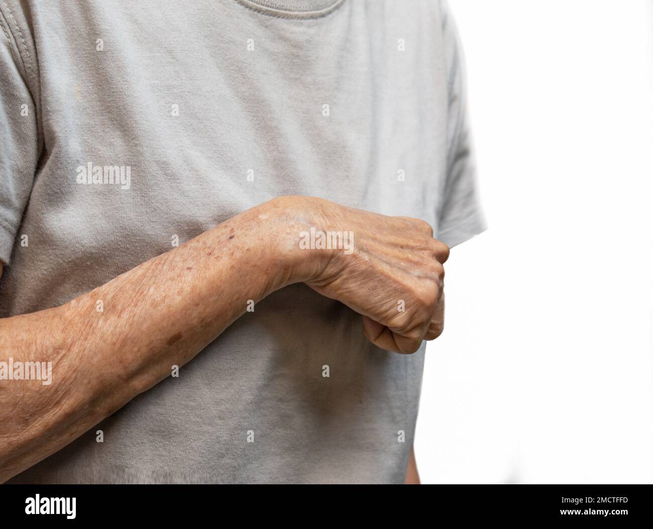 Volkmann contracture in left upper limb of Southeast Asian old woman ...