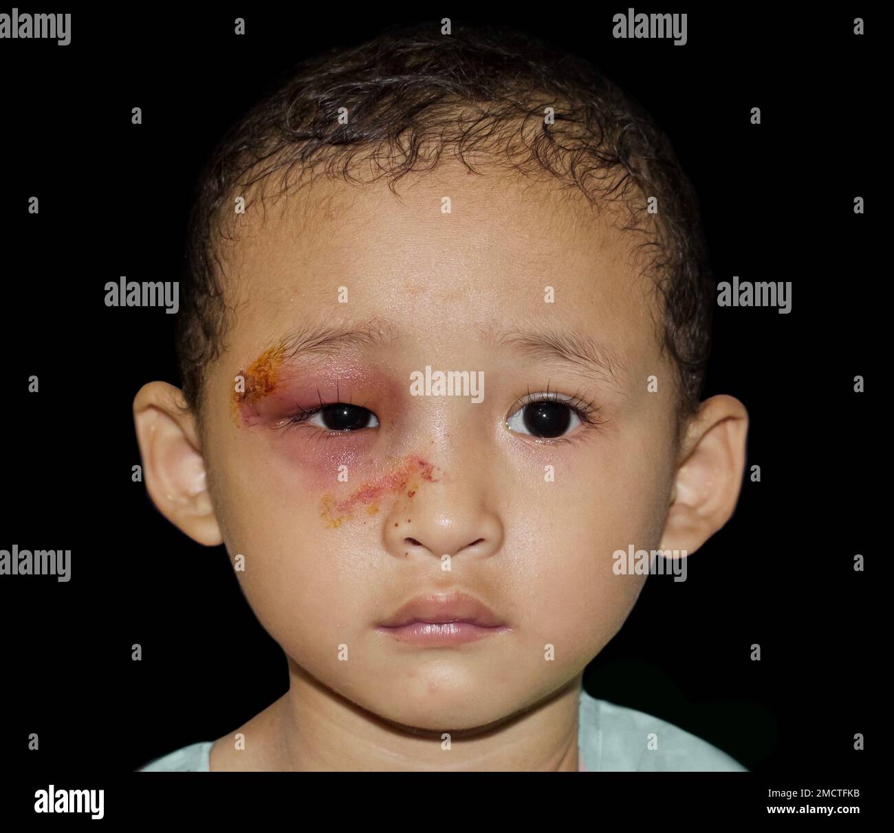 Injury to right eye of Asian male child. Impetigo at the face Stock ...