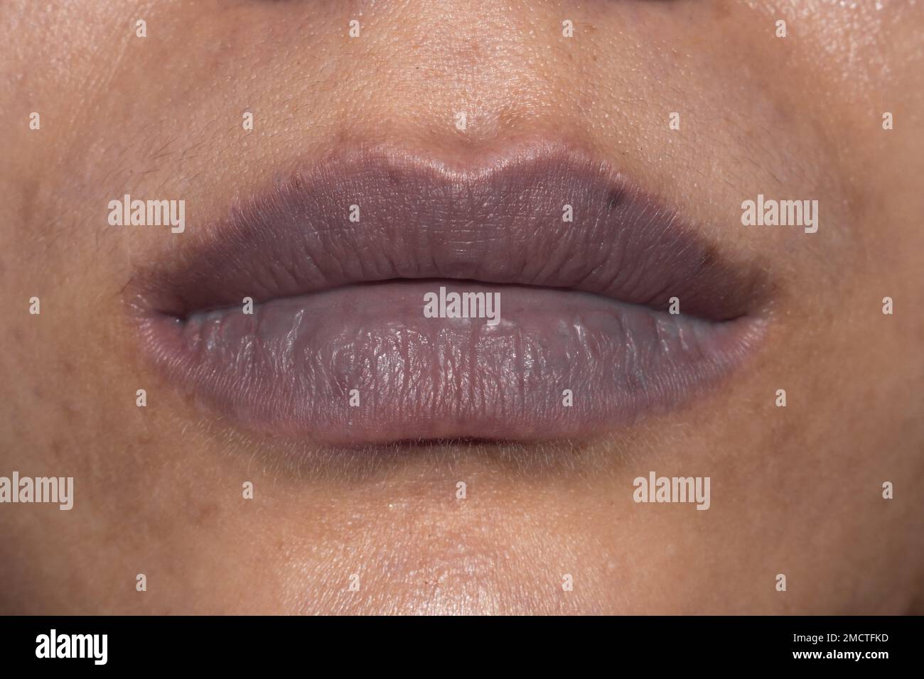 Central cyanosis in Southeast Asian young woman Stock Photo - Alamy