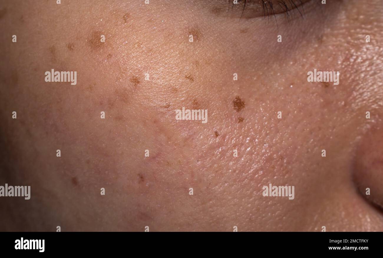 Liver spots on face hi-res stock photography and images - Alamy