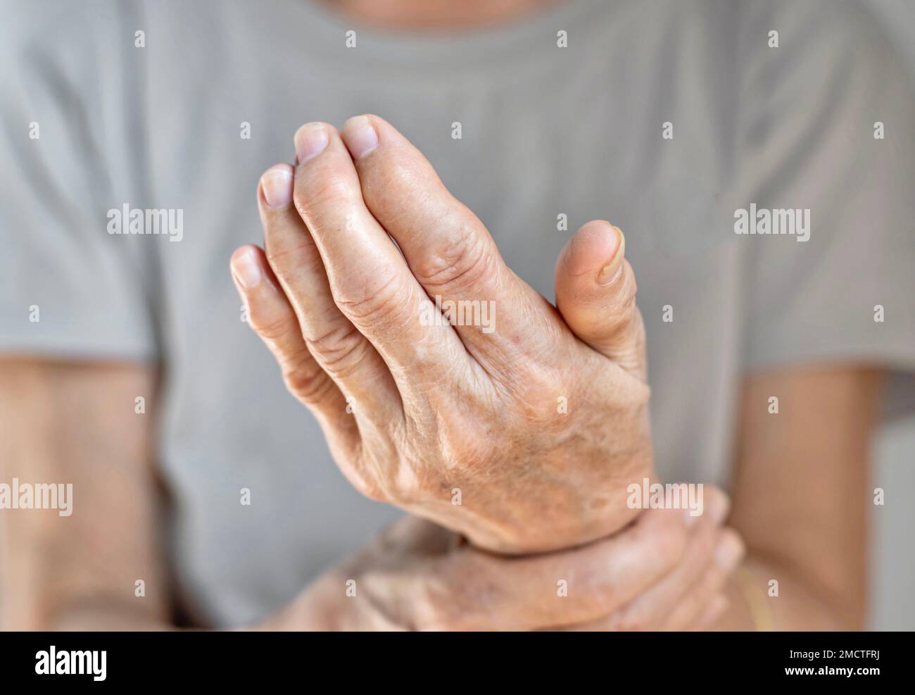 Inflammation of hand joints. Concept and idea of rheumatic arthritis ...