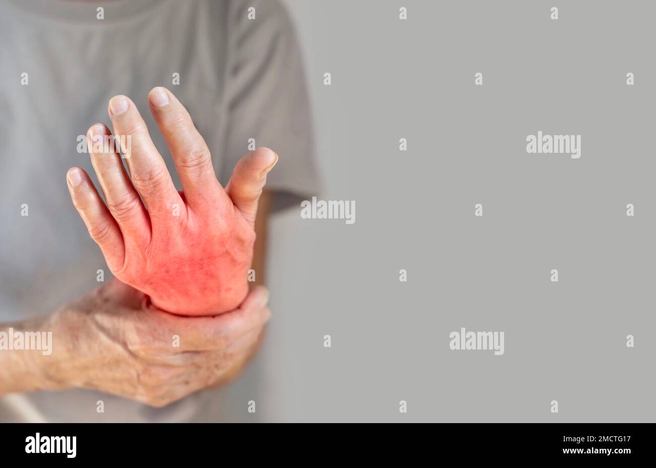 Hand joints inflammation. Concept and idea of rheumatic arthritis ...