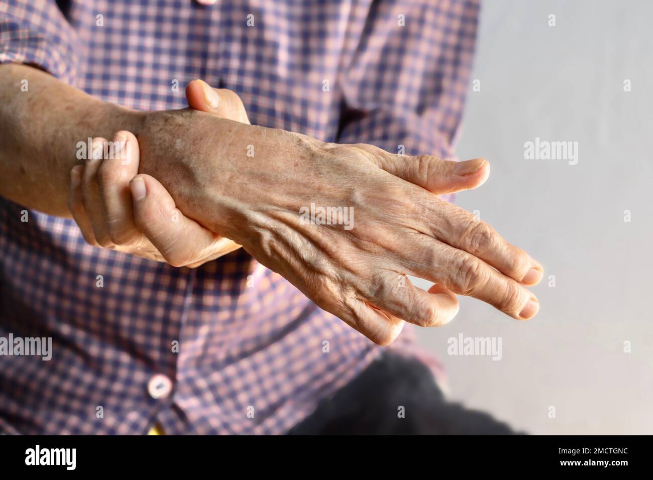 Ulnar claw hand of Asian elder woman. It develops due to ulnar nerve ...