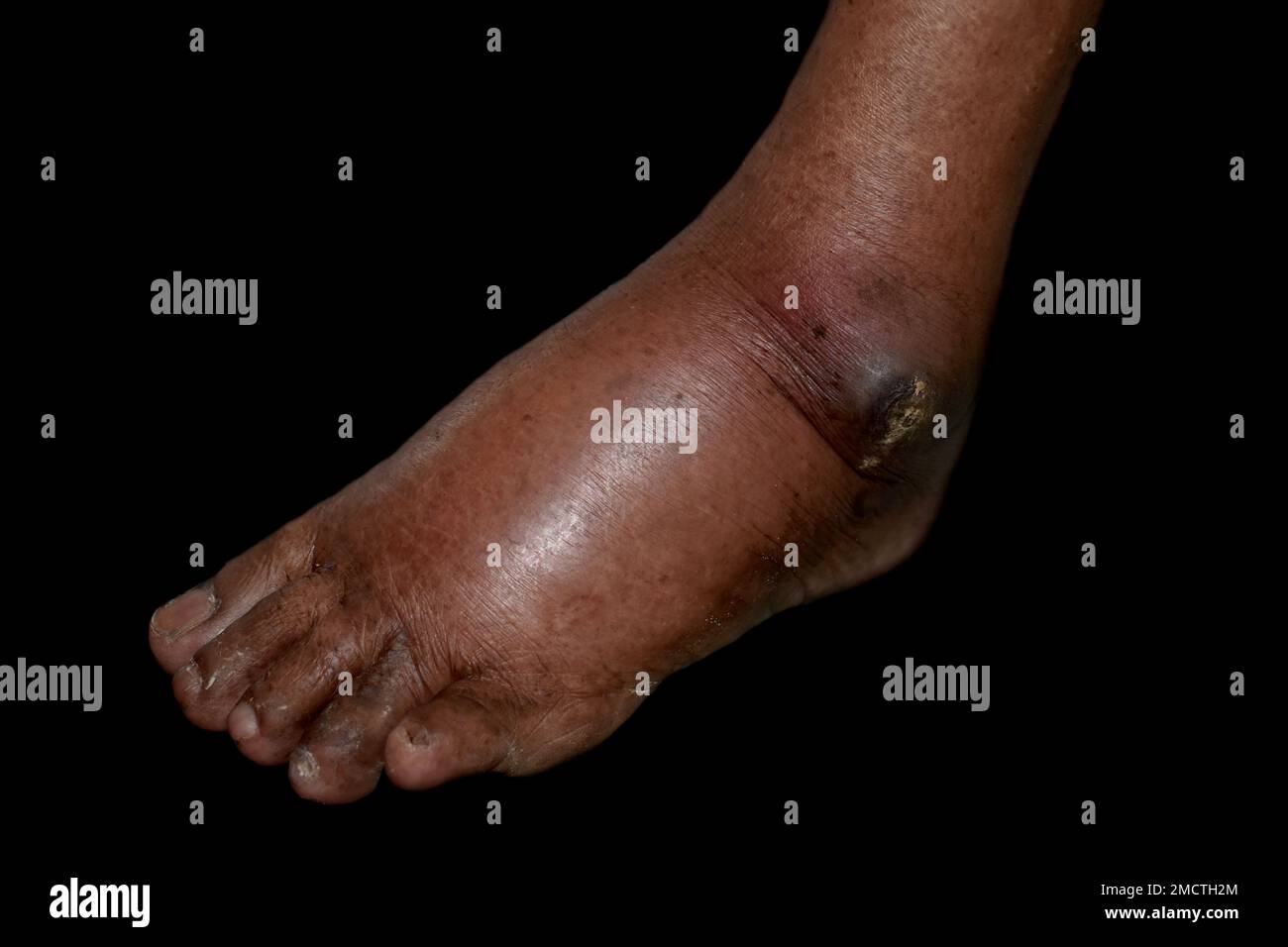 Foot Edema Unilateral at Juanita Morris blog