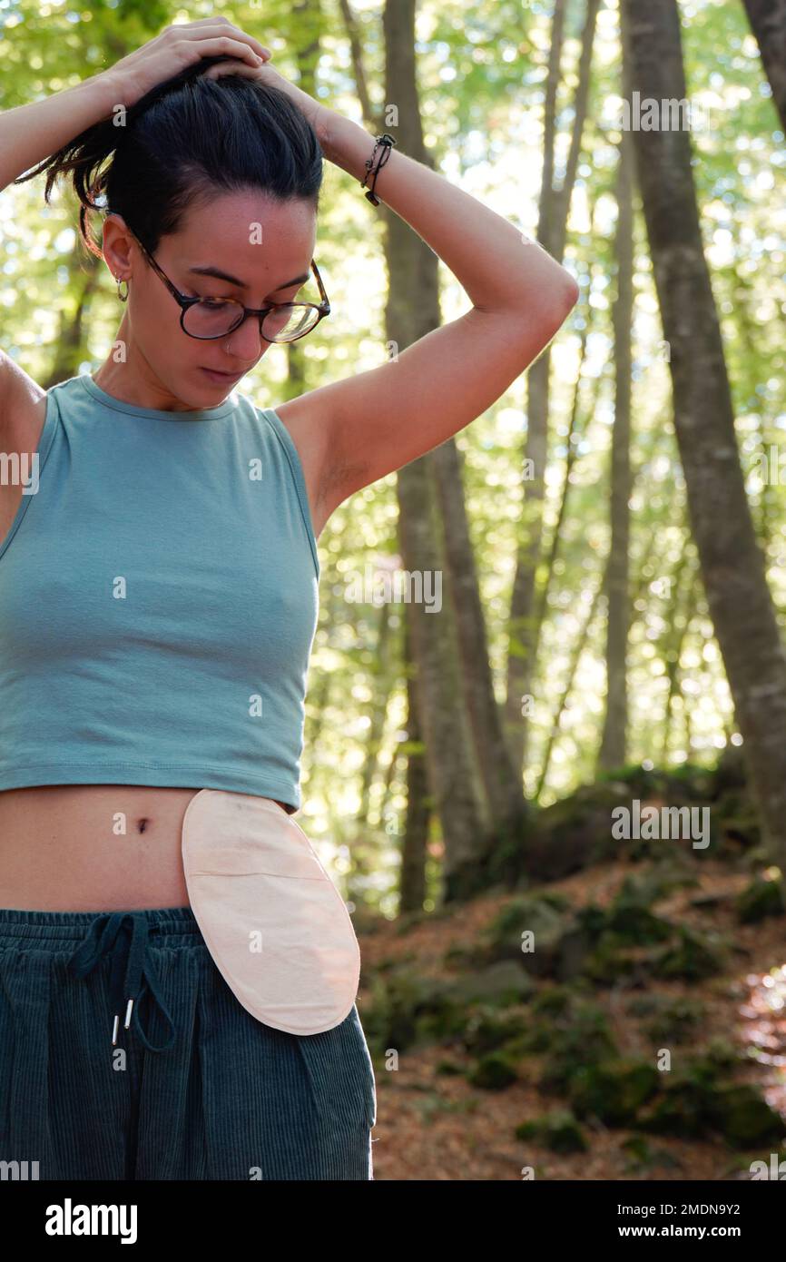 Cancer survivor woman showing an ostomy bag on her abdomen in nature ...