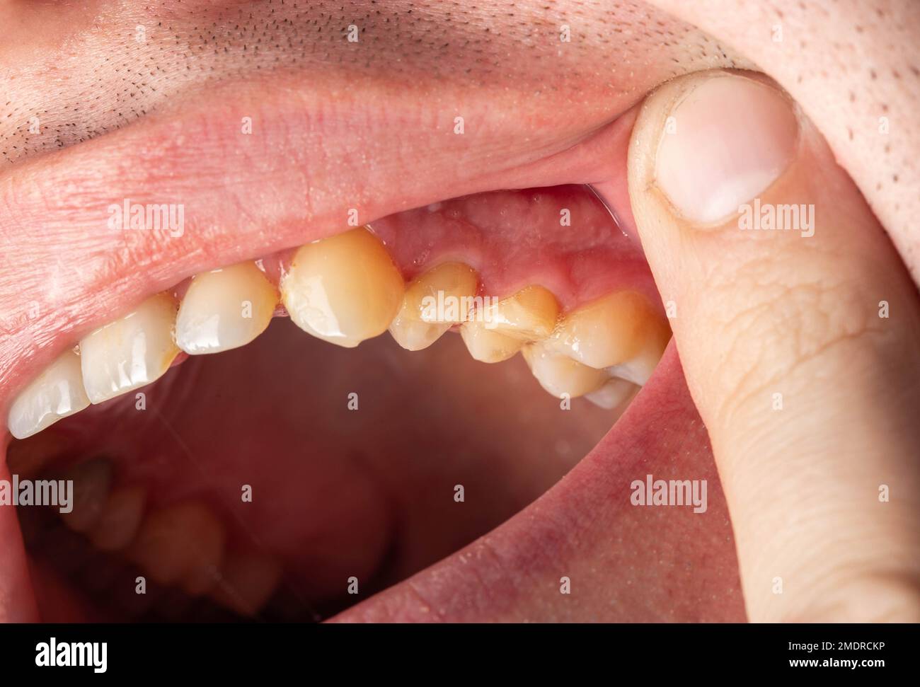Dissected teeth in the patient's mouth during crown prosthetics ...