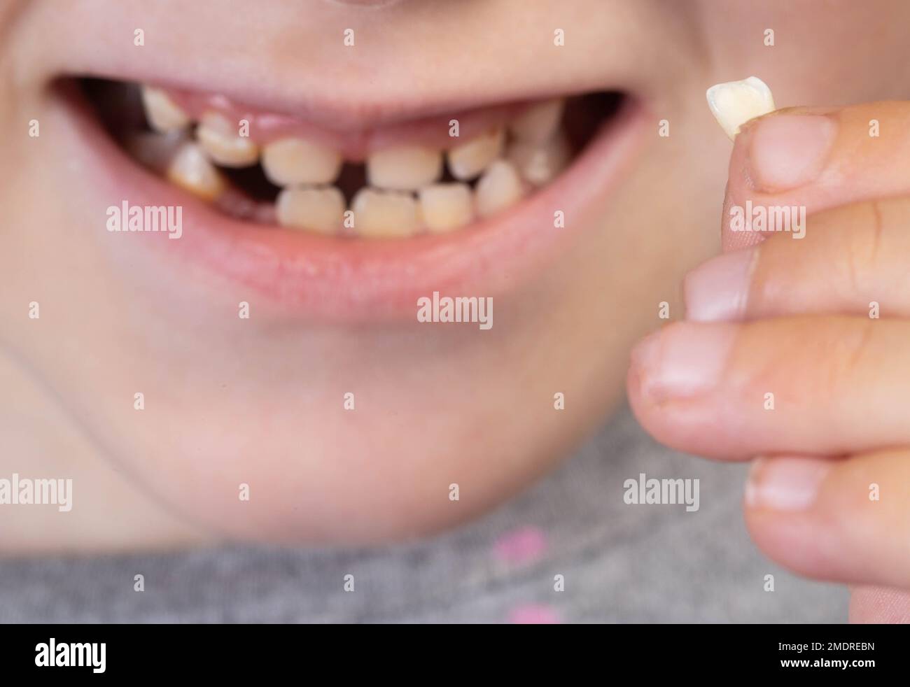 The child holds a milk tooth incisor in his hand. Extraction of milk teeth in children. Children ...