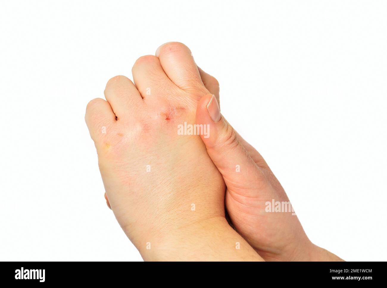 Woman checking the hand with very dry skin and deep cracks Stock Photo ...