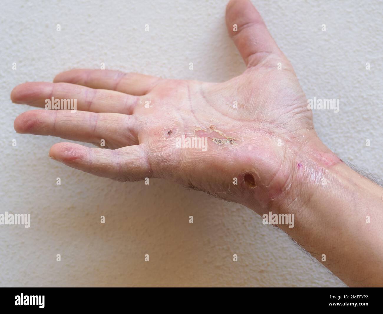 electric shock entry and exit wounds and burns in 50s adult caucasian ...